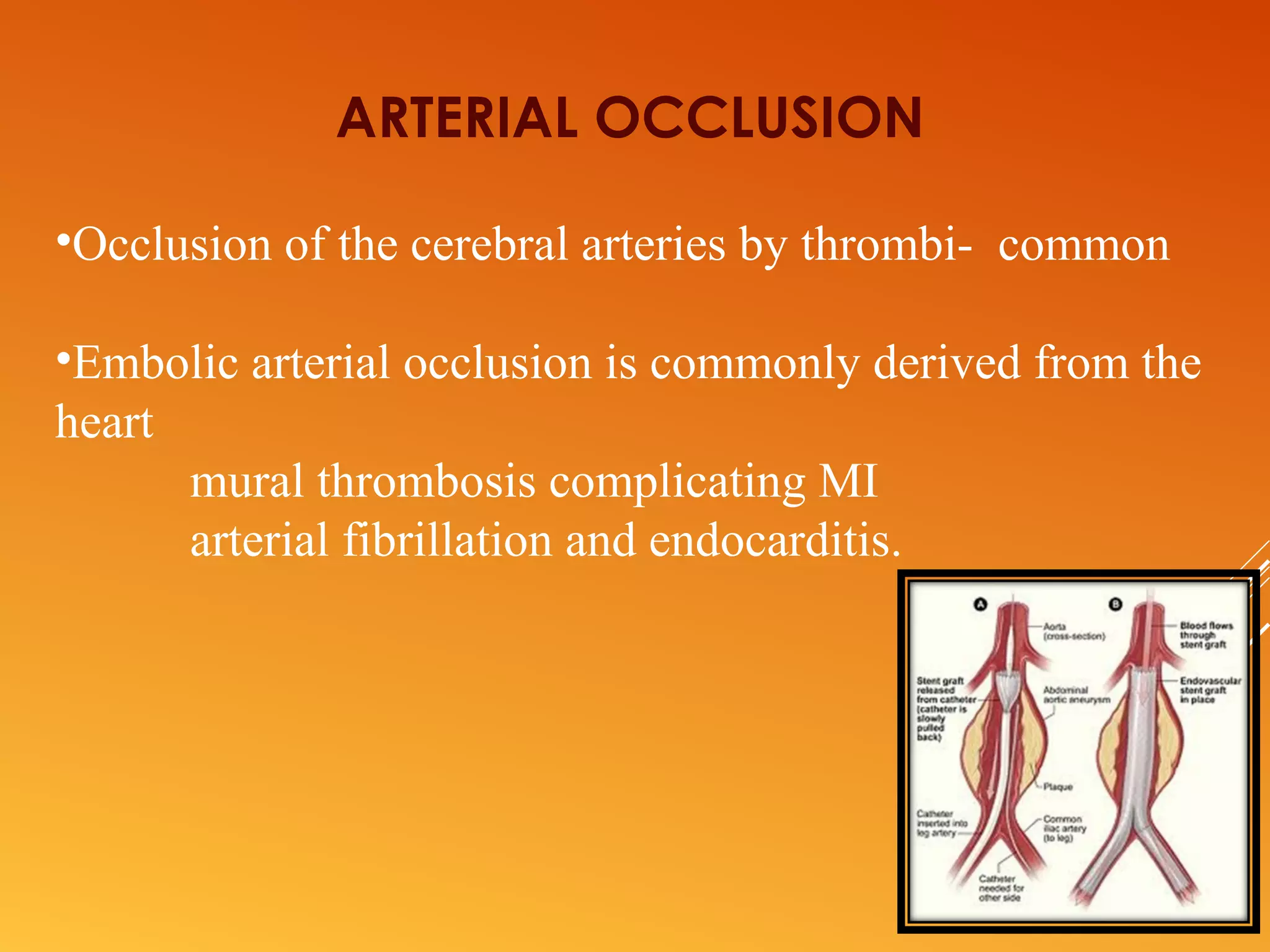 Infarction | PPT