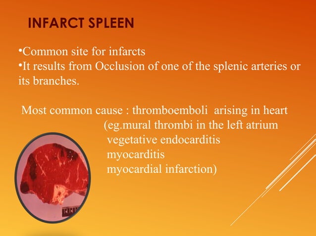 Infarction | PPT | Heart and Cardiovascular Diseases | Diseases and ...