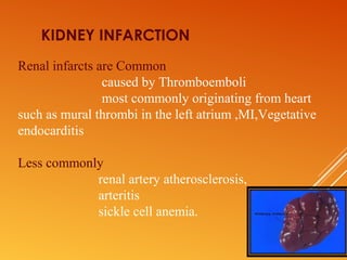 Pale Infarct Kidney