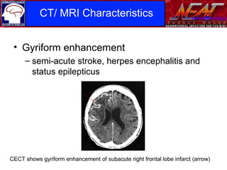 Infarction and some important lesions mimicking brain tumour | PPT
