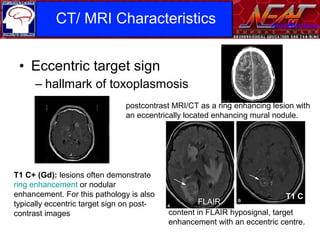 Infarction and some important lesions mimicking brain tumour | PPT