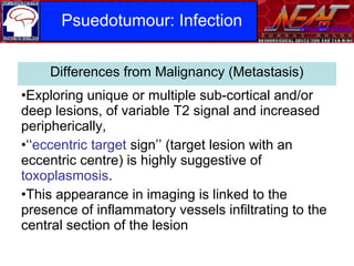 Infarction and some important lesions mimicking brain tumour | PPT