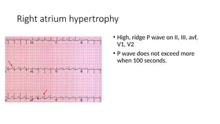 Myocardial infarction and pathology, Complications | PPT