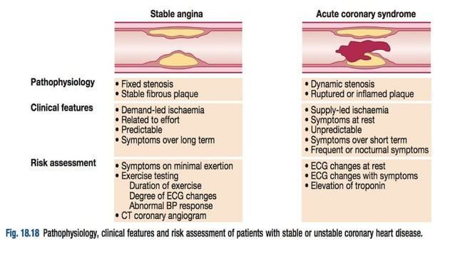 Myocardial infarction and pathology, Complications | PPT