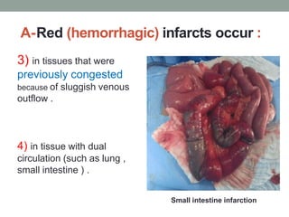 Infarction Path-201.pptx