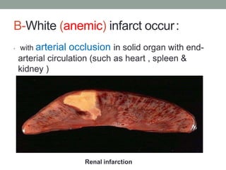 Infarction Path-201.pptx