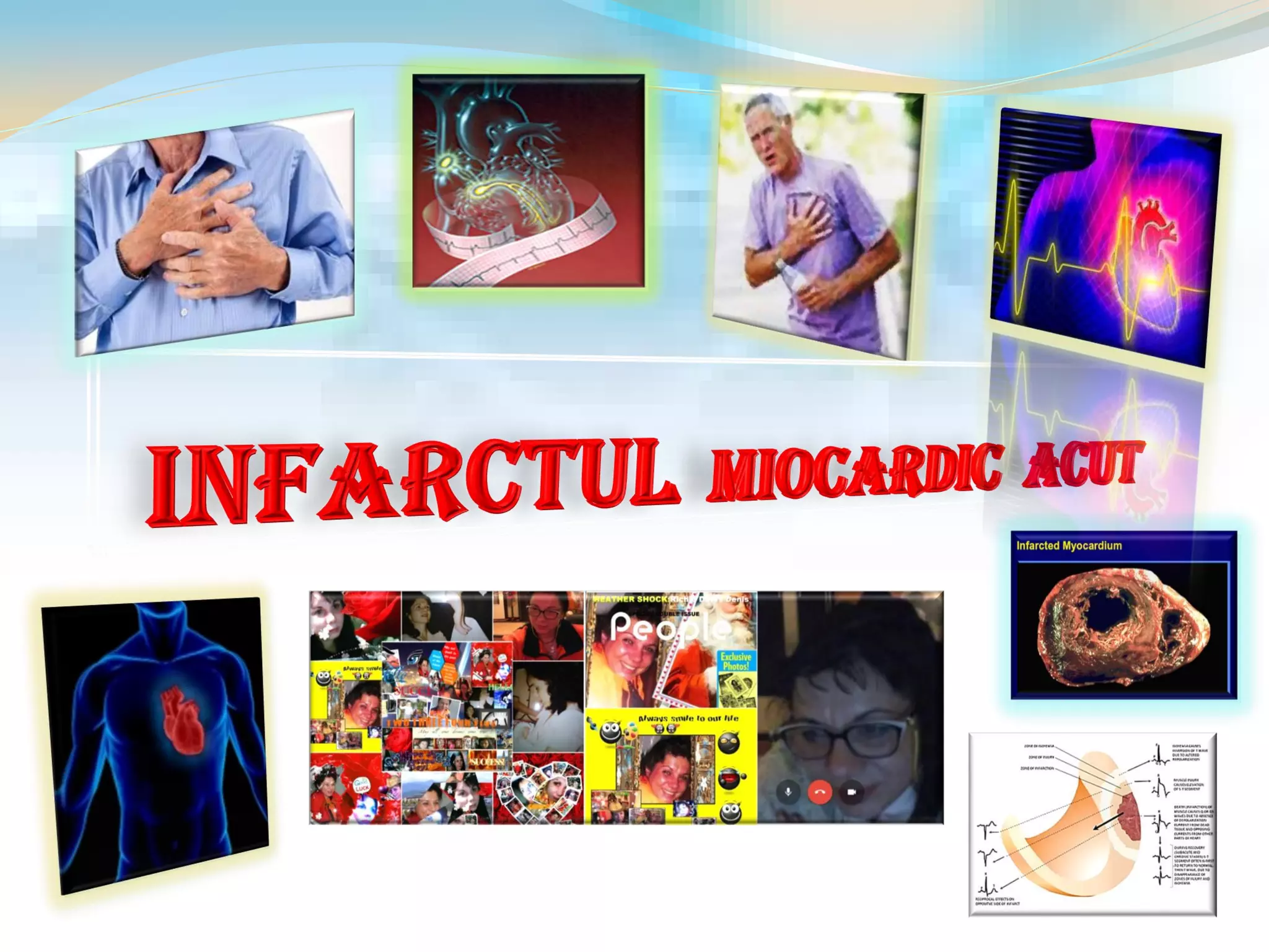 Infarctul miocardic acut | PDF