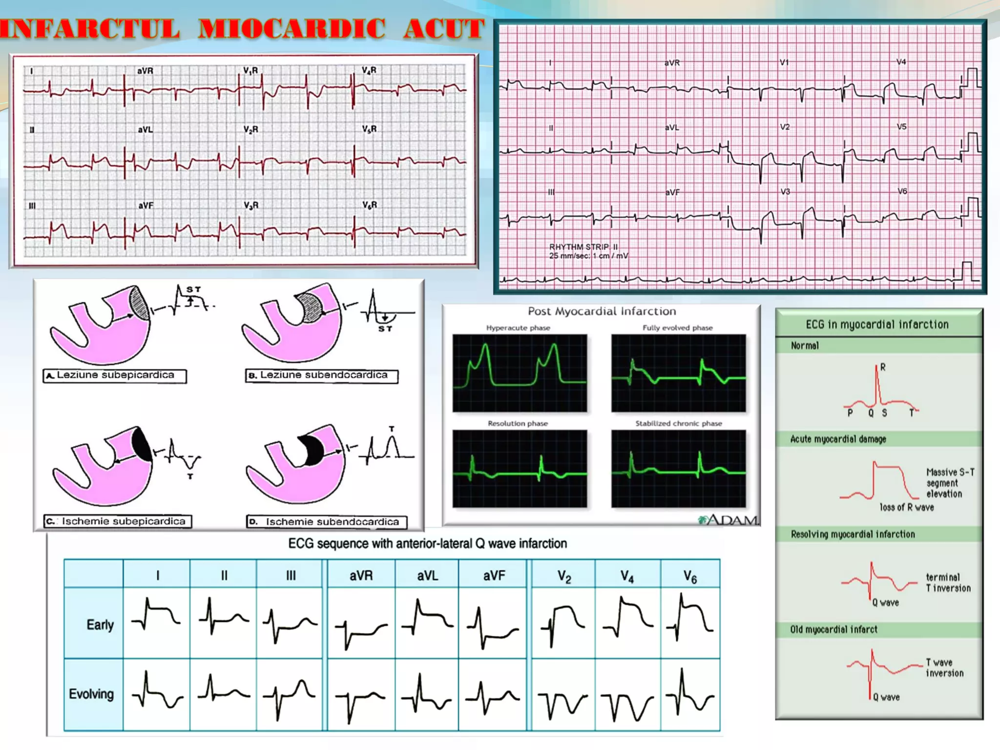 Infarctul miocardic acut | PDF