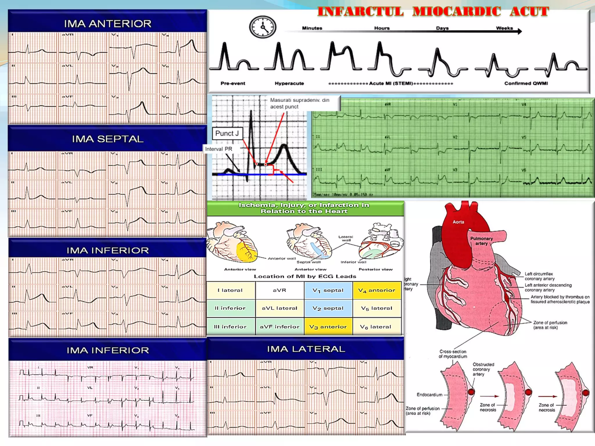 Infarctul miocardic acut | PDF