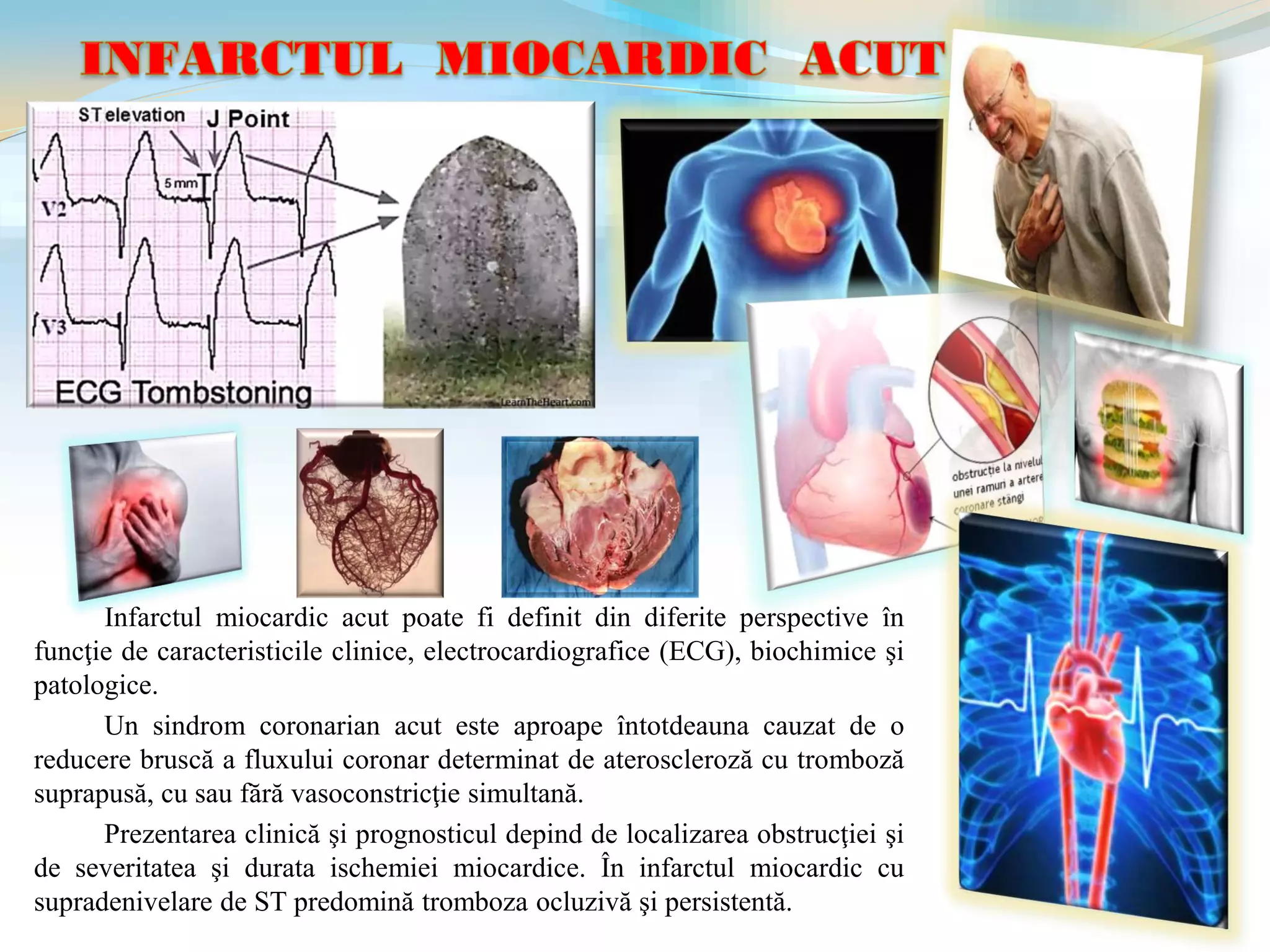 Infarctul miocardic acut | PDF