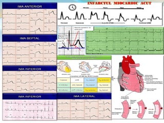 Infarctul miocardic acut | PDF