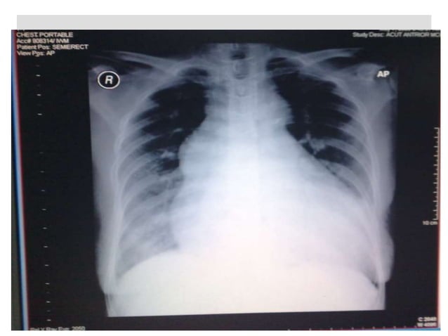 Infark miokardium | PPTX