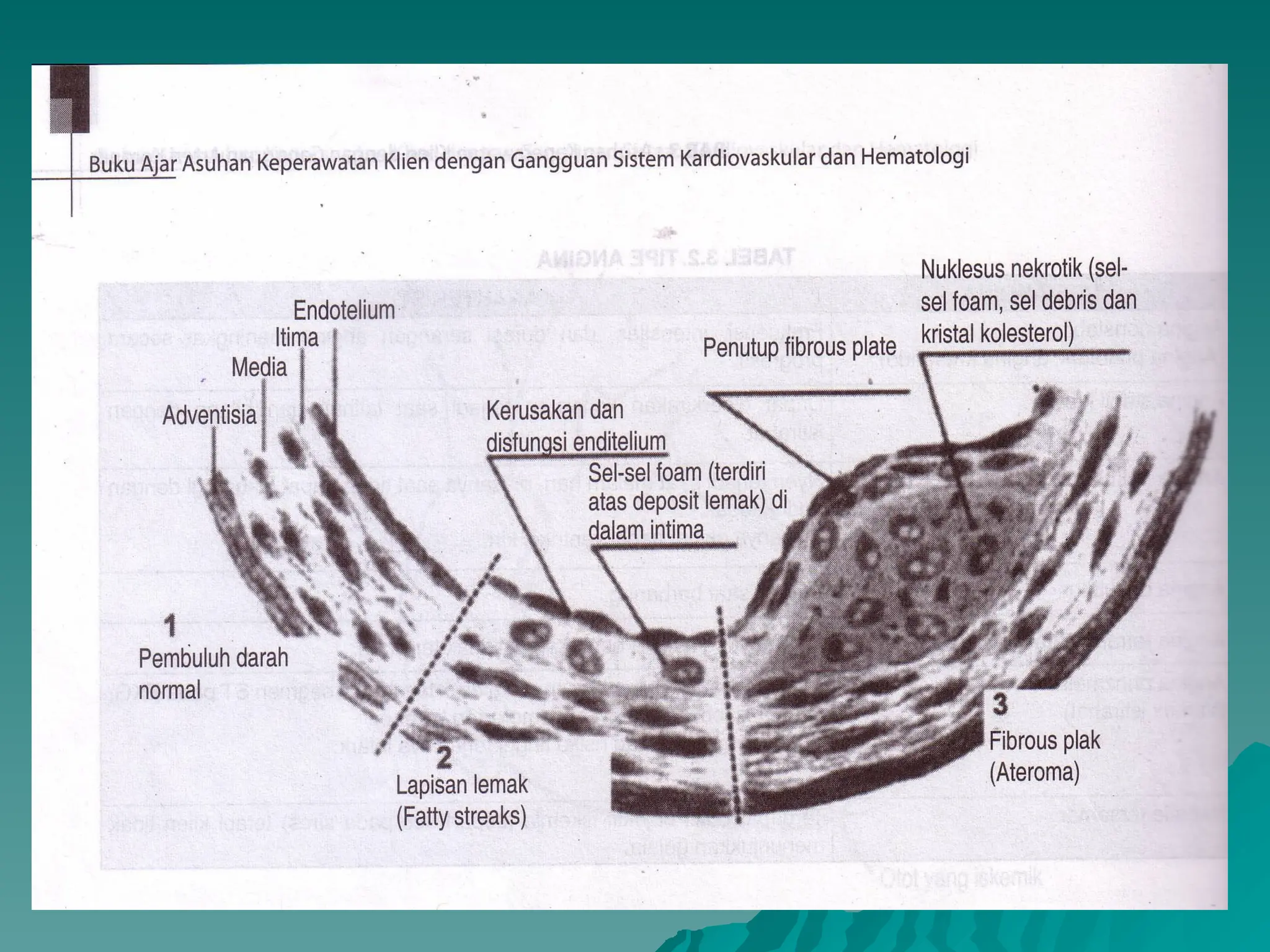 KONSEP INFARK MIOKARDIUM DAN PENATALAKSANAANNYA | PPT