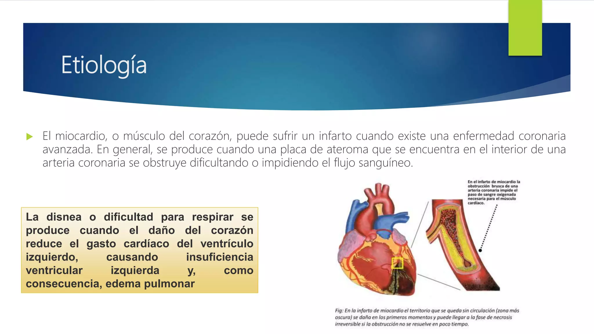Infarto Agudo de Miocardio IMA | PPTX | Heart and Cardiovascular ...