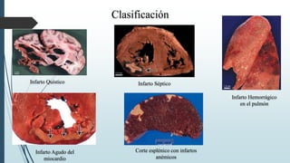 Infarto.pptx