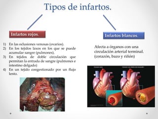 infarto | PPTX