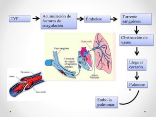 infarto | PPTX
