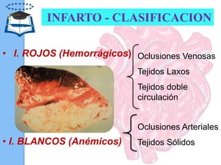 Infarto acosta | PPTX