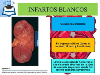 Infarto acosta | PPT