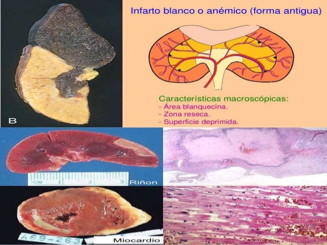 Infarto acosta