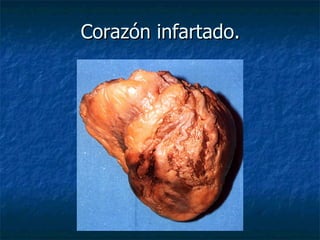 Infarto Agudo Al Miocardio | PPT