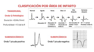 Infarto Agudo al Miocardio Abraham Portillo.pptx