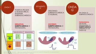 Infarto Agudo al Miocardio con Elevación del Segmento.pptx