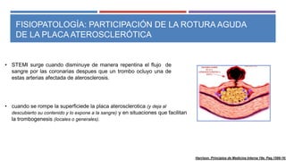 Infarto agudo al miocardio con elevacion del segmento st | PPTX