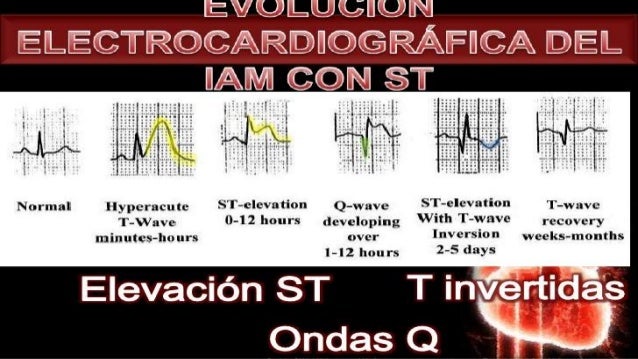 Infarto agudo del miocardio con elevación del segmento st