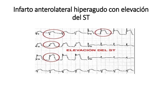 Infarto agudo del miocardio con elevación del segmento st