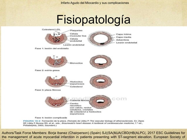 Infarto agudo del miocardio y sus complicaciones | PPTX | Physical ...