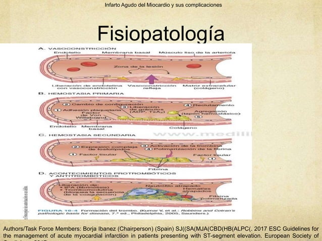 Infarto agudo del miocardio y sus complicaciones | PPTX | Physical ...