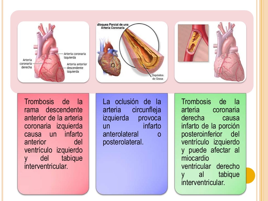 Infarto Agudo Do Miocárdio Fisiopatologia - RETOEDU