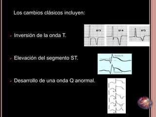 Infarto agudo miocardio | PPTX