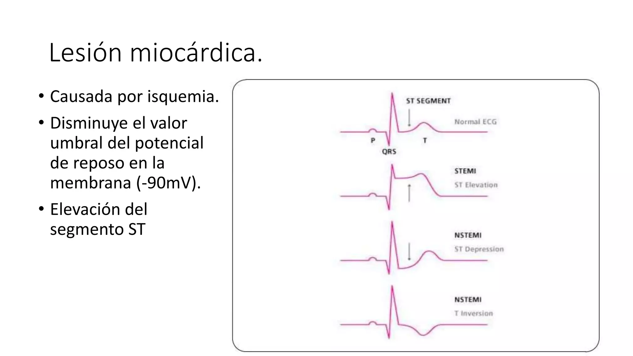 Infarto al miocardio | PPT