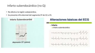 Infarto al miocardio | PPTX