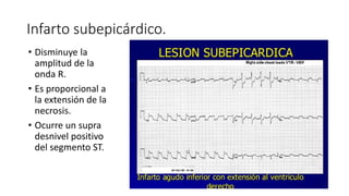 Infarto al miocardio | PPTX