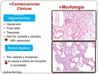 Infarto y shock | PPTX