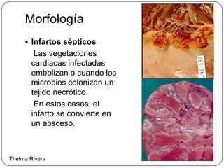 Infarto y shock | PPTX