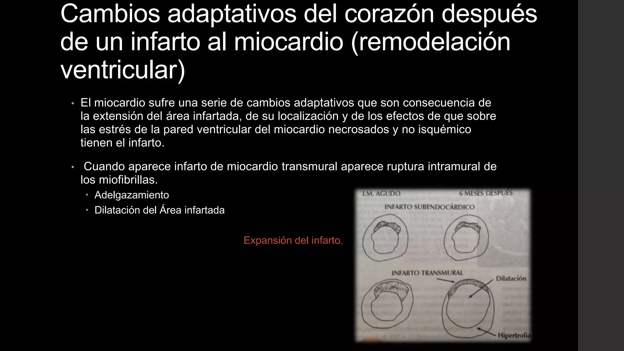 Infarto del miocardio | PPT