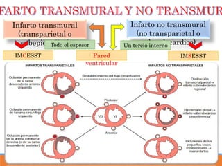 Infarto de miocardio | PPTX