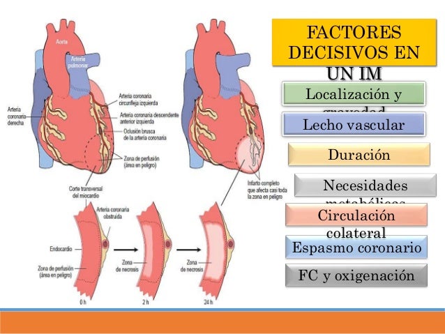 Infarto de miocardio