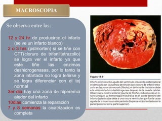 Infarto de miocardio | PPTX