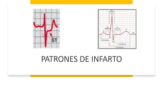Infarto de miocardio sin elevación del ST.pptx
