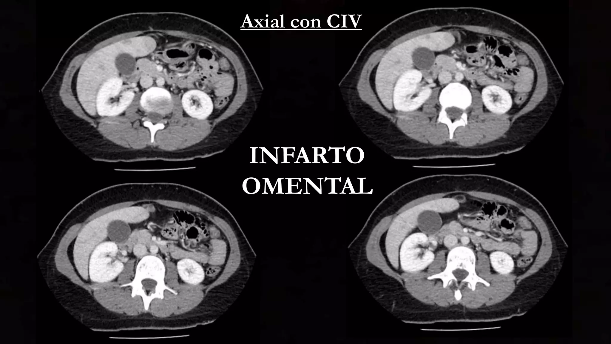 Lectura de caso. infarto omental | PPTX
