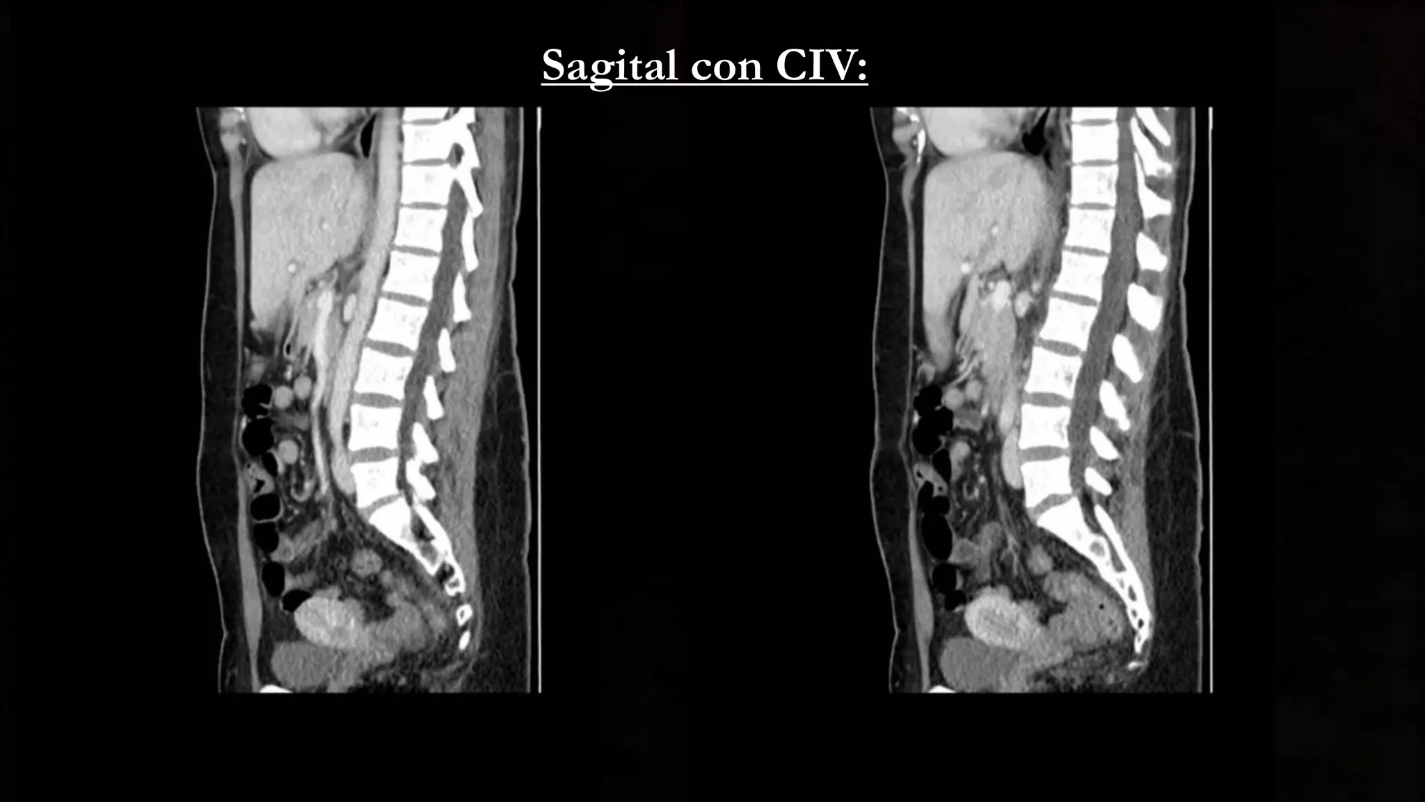 Lectura de caso. infarto omental | PPTX