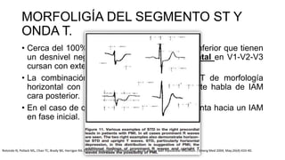 Infarto posterior criterios electrocardiograficos | PPTX
