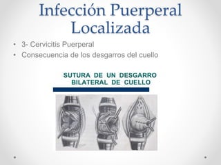 Infección puerperal para estudiar | PPTX