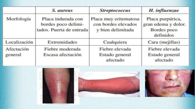 Infección de Piel y Tejidos Blandos