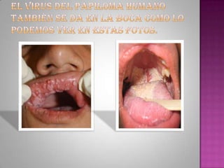 Infección por virus del papiloma humano (vph) | PPTX